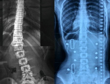 Moderate Scoliosis: Symptoms, Diagnosis, and Treatment – Denver