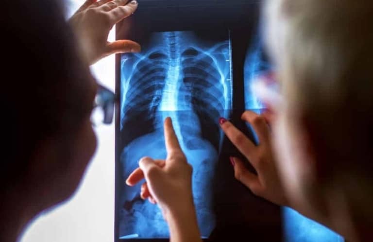 In-brace X-rays in AIS Patients Wearing Full-time TLSO Braces