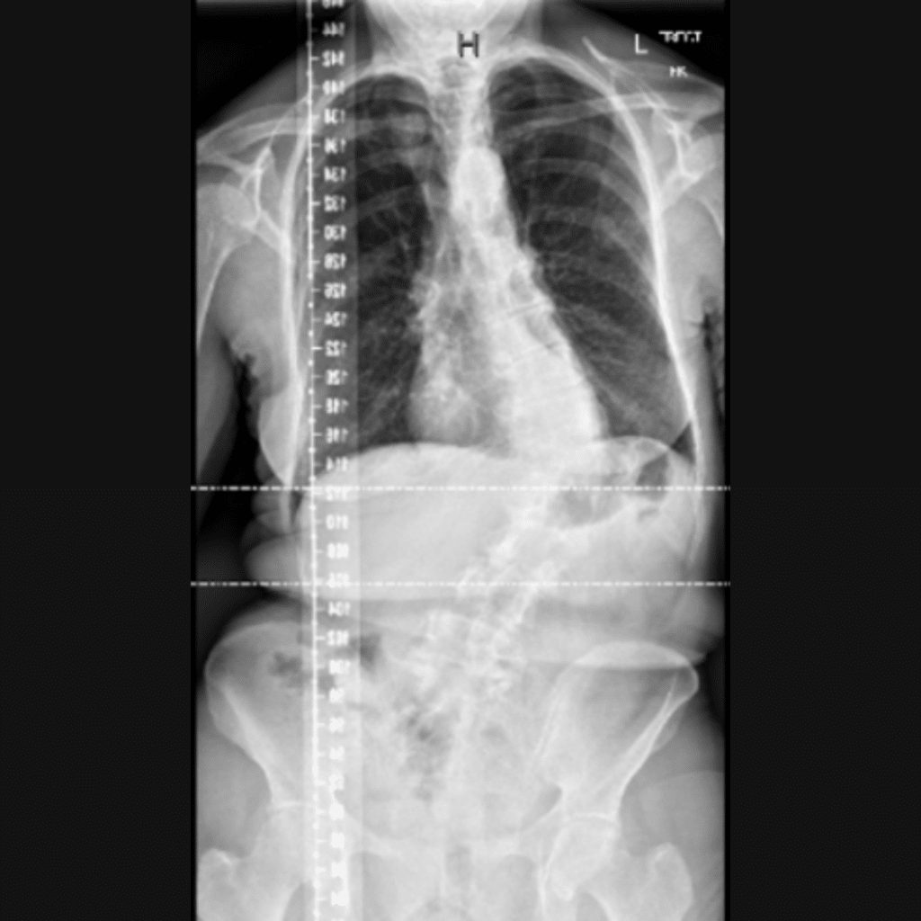 Cobb Angle is Not the Most Important Consideration with Adult Scoliosis ...