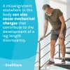 Leg Length Discrepancy: Causes, Effects & Solutions – ScoliCare